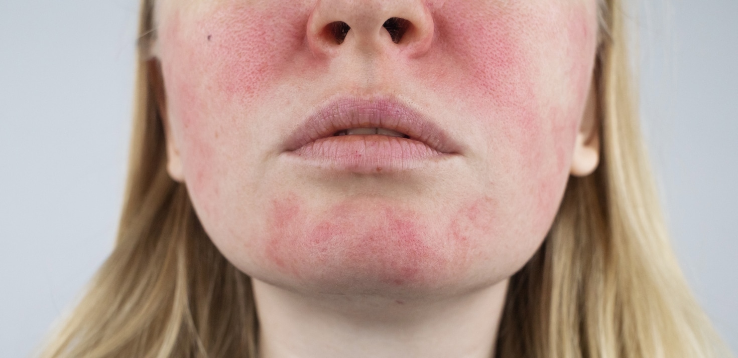 What is the Link Between Rosacea and Allergies? | Charleston ENT ...